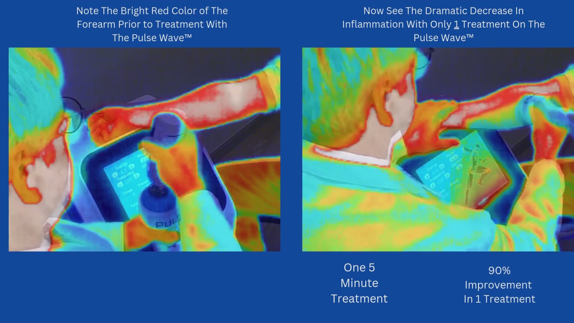 Pulse Wave | Shockwave Therapy Pro